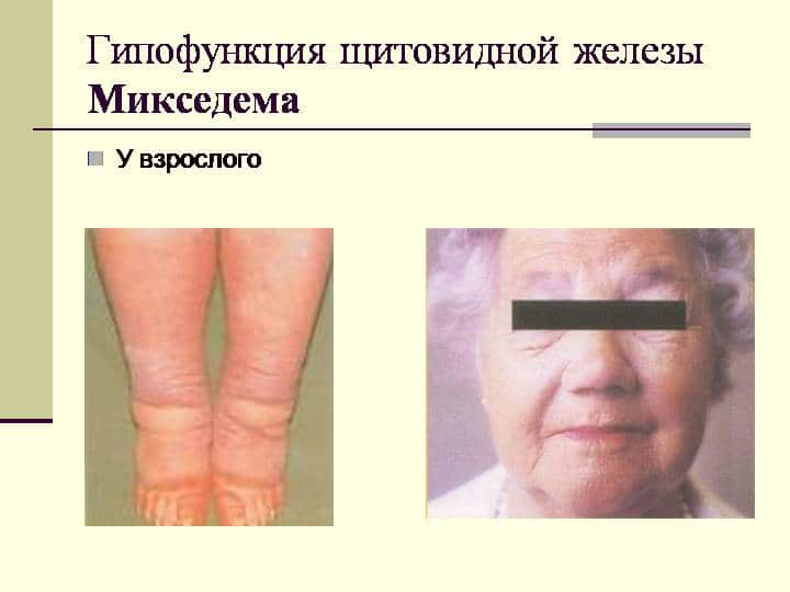 Микседема. Причины и симптомы патологии щитовидной железы